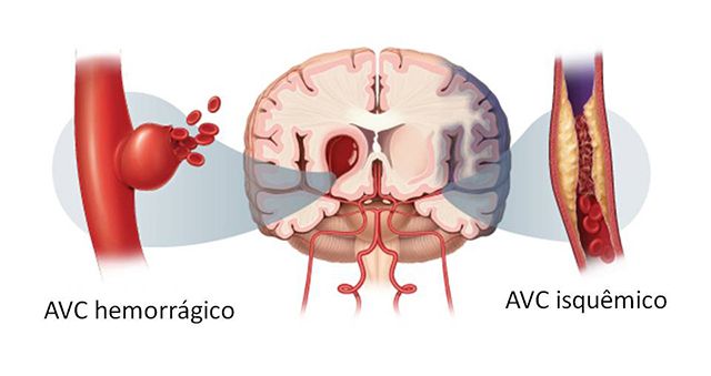 Acidente Vascular Cerebral: Fique atento!