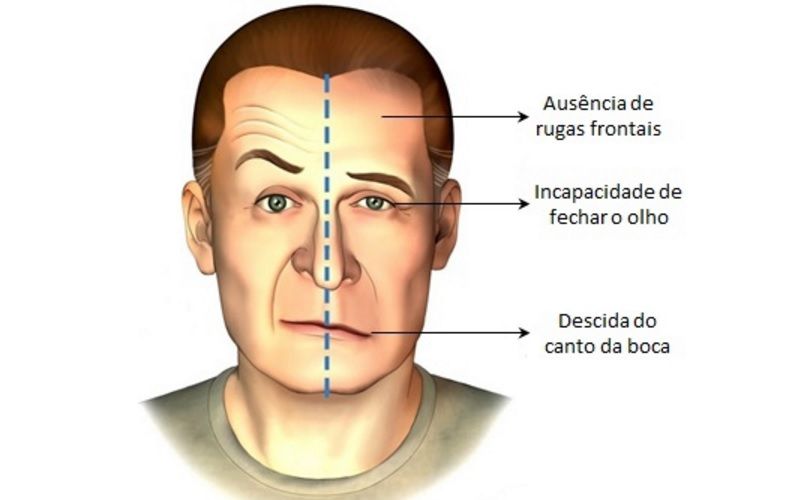 Acidente Vascular Cerebral: Fique atento!